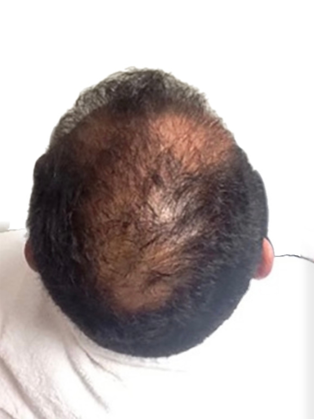 Clínica Especializada en Caída del Cabello - Svenson